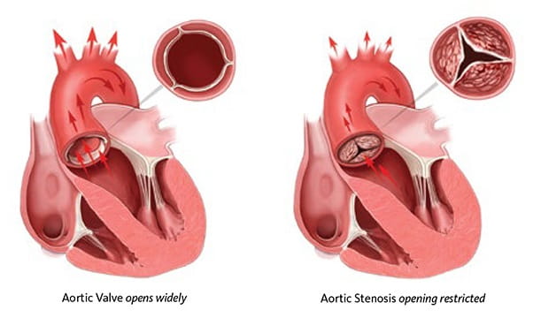 Aortic Stenosis